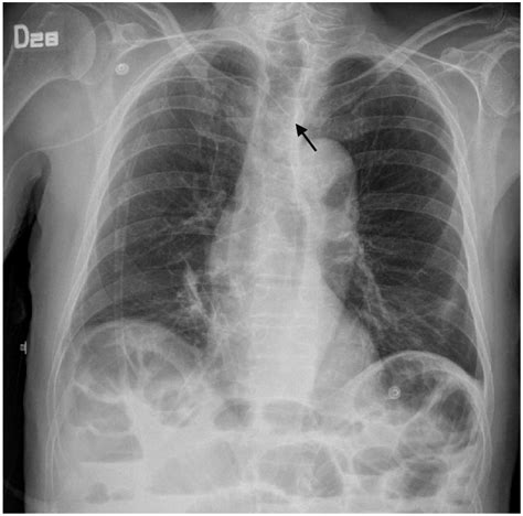 Chest Radiograph Following The Right Picc Placement Note The Position Download Scientific