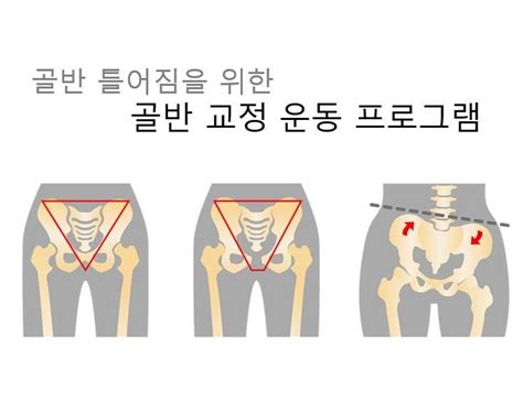 골반교정 운동 프로그램1 골반전방경사 편 네이버 포스트 2020 척추 측만증 운동 운동 운동 아이디어