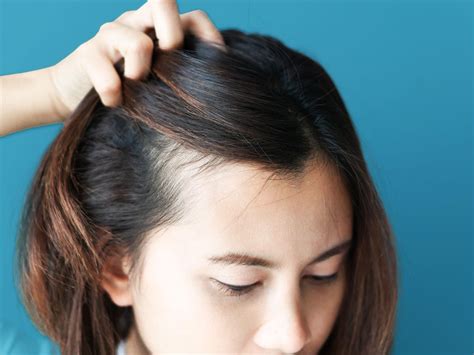 Dry Scalp Flakes Dry Scalp Flakes