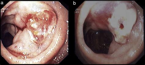 Irregular Polypoid Eroded Mass 1 Cm In The First Portion Of The