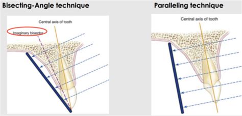Periapical Radiography Using Bisecting Angle Technique Flashcards Quizlet