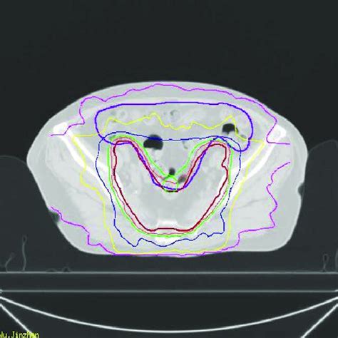 Auto Vmat Plan Isodose Curve Distribution Auto Vmat Automatic Download Scientific Diagram