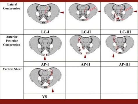 Pelvic And Acetabular Fractures Pelvic And Acetabular Fractures