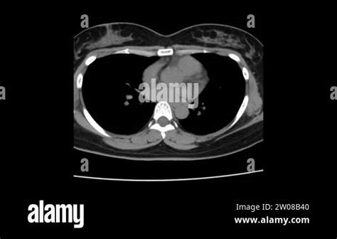 Cta Of Abdomen Stock Videos Footage HD And 4K Video Clips Alamy