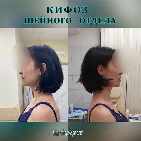 Кифоз шейного отдела и его лечение Медицинский кабинет невролога Солоповой И П