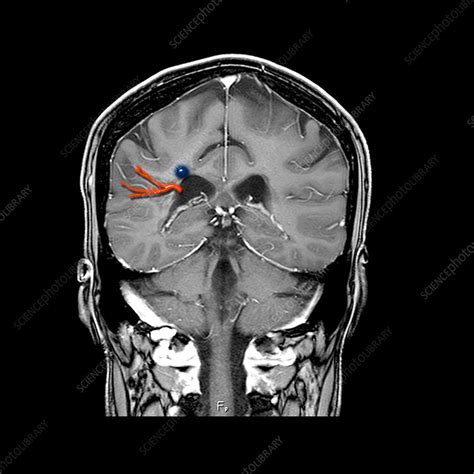 Developmental Venous Anomaly Stock Image C0034617 Science Photo