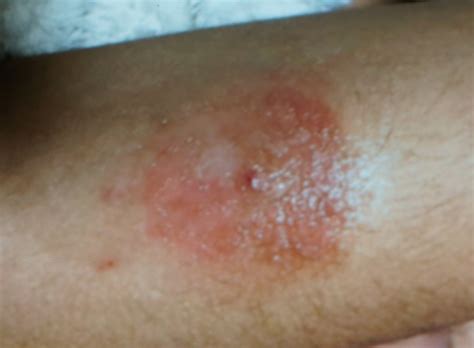 Allergic Contact Dermatitis Caused By Isobornyl Acrylate When Using The