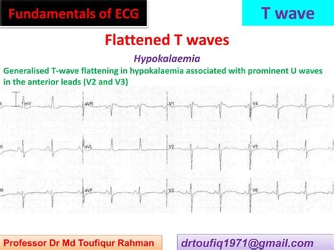 Approach To A Patient With T Wave Abnormality In Ecg Ppsx Heart And Cardiovascular Diseases
