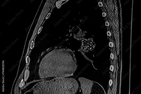 Lateral View Of Chest Cat Scan That Shows Popcorn Calcification A Hamartoma Tumor On The Left