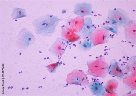 View In Microscopic Of Candidiasis Fungus Infection Yeast And