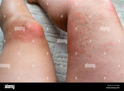 Allergic Rash On The Leg Photodermatitis Allergy To The Sun