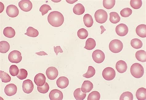 Anemia Hemolytic Anemia Hemolytic Acquired Anemia