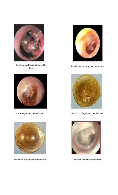 Tympanic Membrane Dr Fadil Pdf