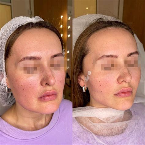 Подтяжки лица нитями с насечками Cog Коги цена от 4 000 руб в Москве Корейские мезонити для