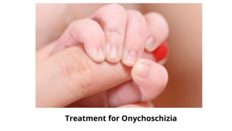 Onychoschizia Causes Symptoms And Treatment