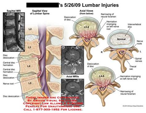 Amicus Illustration Of Amicusinjurylumbarspinediscdesiccation