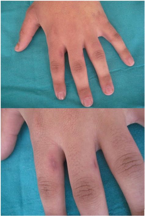 Ablative Co2 Laser For The Treatment Of Pachydermodactyly Actas Dermo