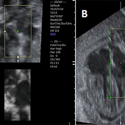 A Image Including The Three Orthogonal Planes Of The Fetal Heart Download Scientific Diagram