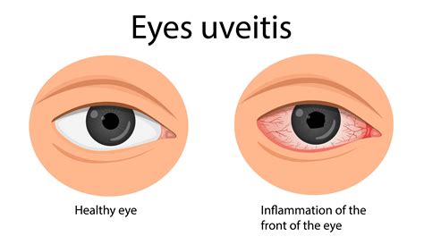 What Is Uveitis What Causes Uveitis Uveitis Symptoms