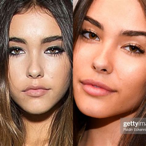 Madison Beer Plastic Surgery Eyebrow Lift Cheek Fillers Madison
