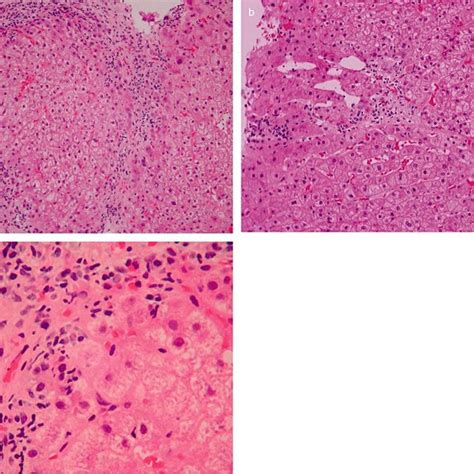 Granulomatous Destructive Cholangitis Florid Duct Lesion In A Liver