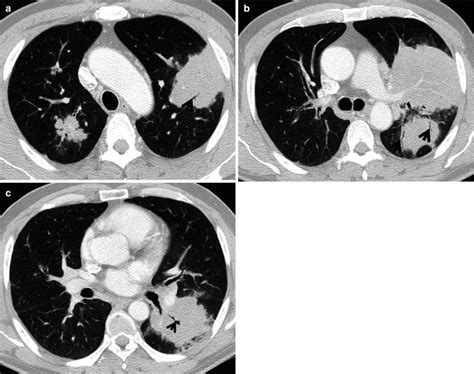 Multiple Nodular Or Mass Like Pattern Radiology Key
