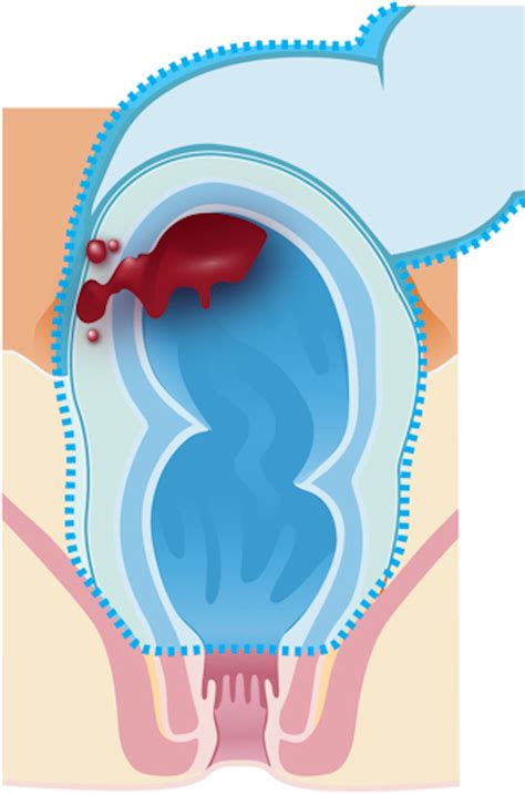 Mri Of Rectal Cancer Tumor Staging Imaging Techniques