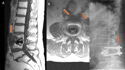 Figure 3 From Lumbar Vertebral Diskitis Osteomyelitis With Mycotic