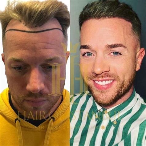 Before After Artofit