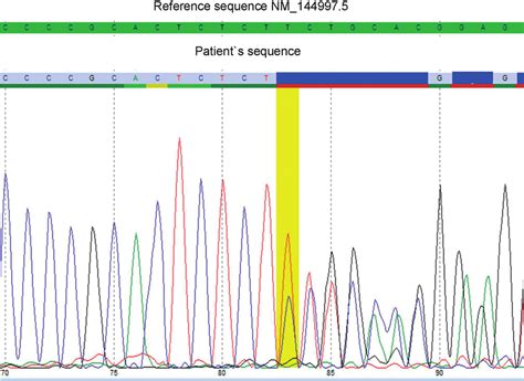 Figure3 Sequence Electropherogram Of Genomic Dna Of The Patient Showing Download Scientific