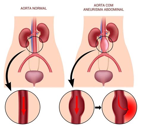 Artigos Aneurisma De Aorta Abdominal