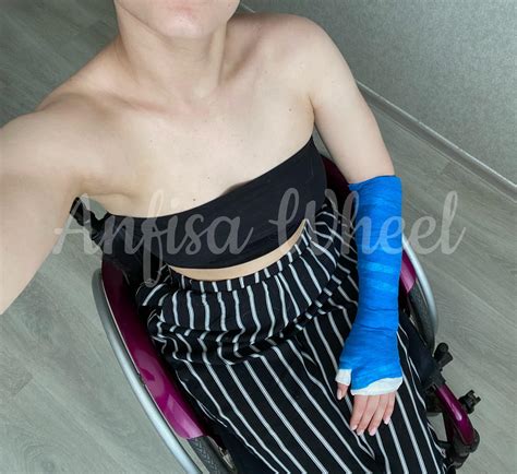 My First Arm Cast Rcastfetish