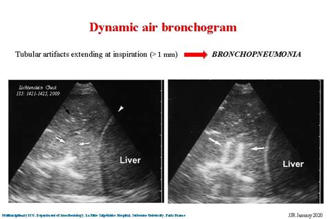 Basic Skills In Transthoracic Lung Ultrasound Antoine Monsel