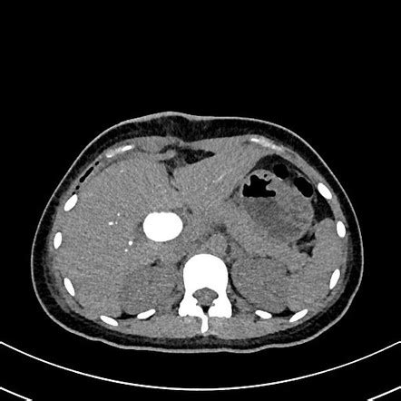 Cholangiogram Procedure