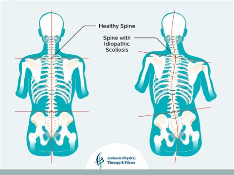 What Causes Adolescent Idiopathic Scoliosis Insights