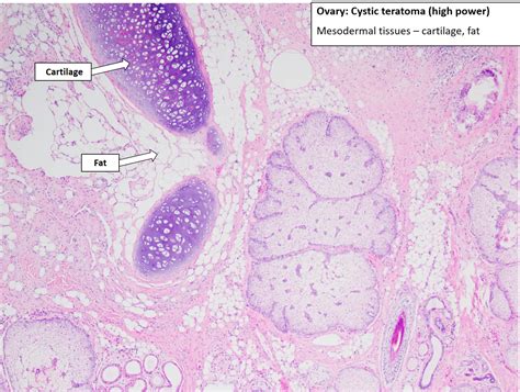 Ovary Cystic Teratoma Nus Pathweb Nus Pathweb