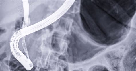 Diagnosztikai módszerek ERCP WEBBeteg