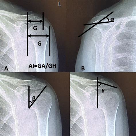 Radiographic Parameters Of Shoulder Joint Parameters A Acromion Index Download Scientific