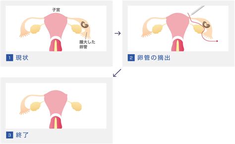 婦人科疾患｜札幌白石産科婦人科病院 腹腔鏡手術・子宮内膜症専門外来サイト