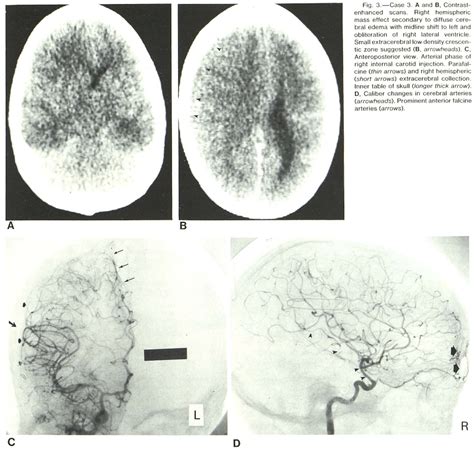 Figure 2 From Neuroradiologic Diagnosis Of Subdural Empyema And Ct Limitations Semantic Scholar
