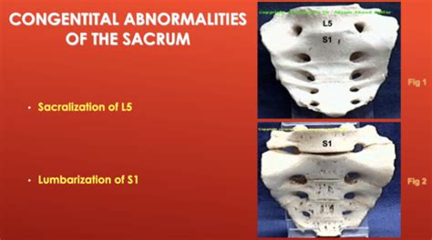 18 Sacral Dx Flashcards Quizlet