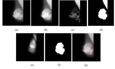 Figure 1 From An Automated Detection And Classification Of Suspicious Lesions In Mammograms