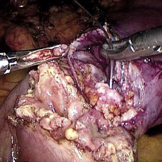 Diagram Of A Duodeno Jejunal Omega Switch With Gastric Plication Download Scientific Diagram