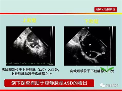 房间隔缺损超声图片 静脉 继发 大山谷图库