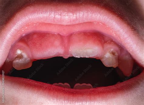 The Eruption Of A Permanent Tooth After The Loss Of A Milk Tooth In A