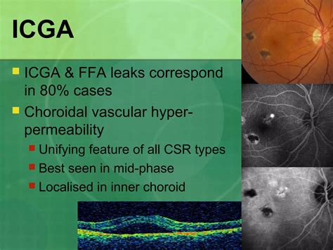 Central Serous Retinopathy Ppt