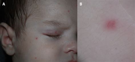 A A Few Bright Red Papules Spread On The Face Which Completely
