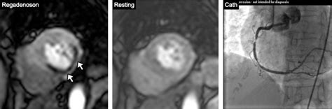 Patient With Perfusion Defect In Inferior And Inferior Lateral Download Scientific Diagram