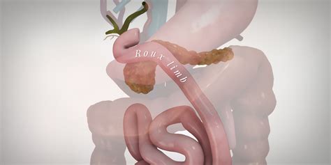 Gastrojejunostomia Hepaticojejunostomia Cholecystojejunostomy And