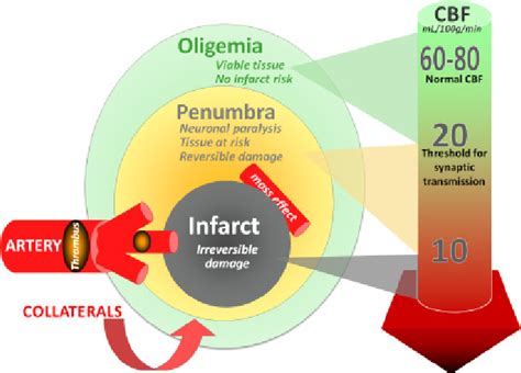 Figure 3 From Imaging Of Acute Ischemic Stroke Semantic Scholar